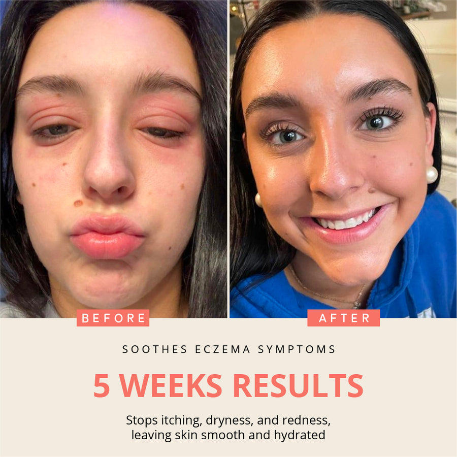 Youzu Rescue Spray + 1 Free Spray